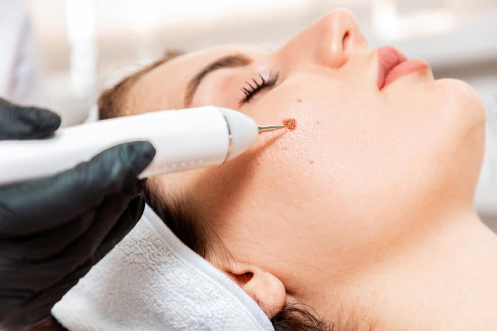 4 Common Types of Moles: When to See a Dermatologist | White Rock ...